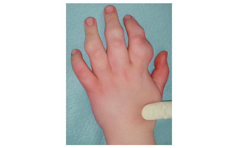 بیماری اولیر، علائم و راه های درمان آن – مجله سلامت دکترتو